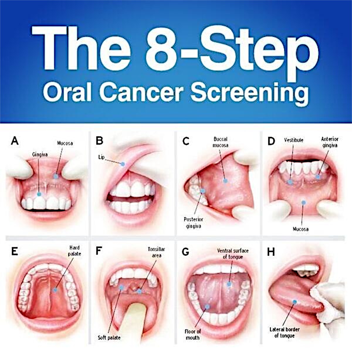 Hpv Bumps On Your Tongue Hpv Hub Llc 5247